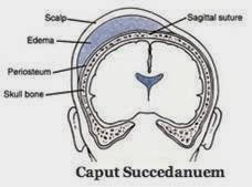 informasi praktis kesehatan anak: Benjolan pada Kepala pada bayi baru lahir