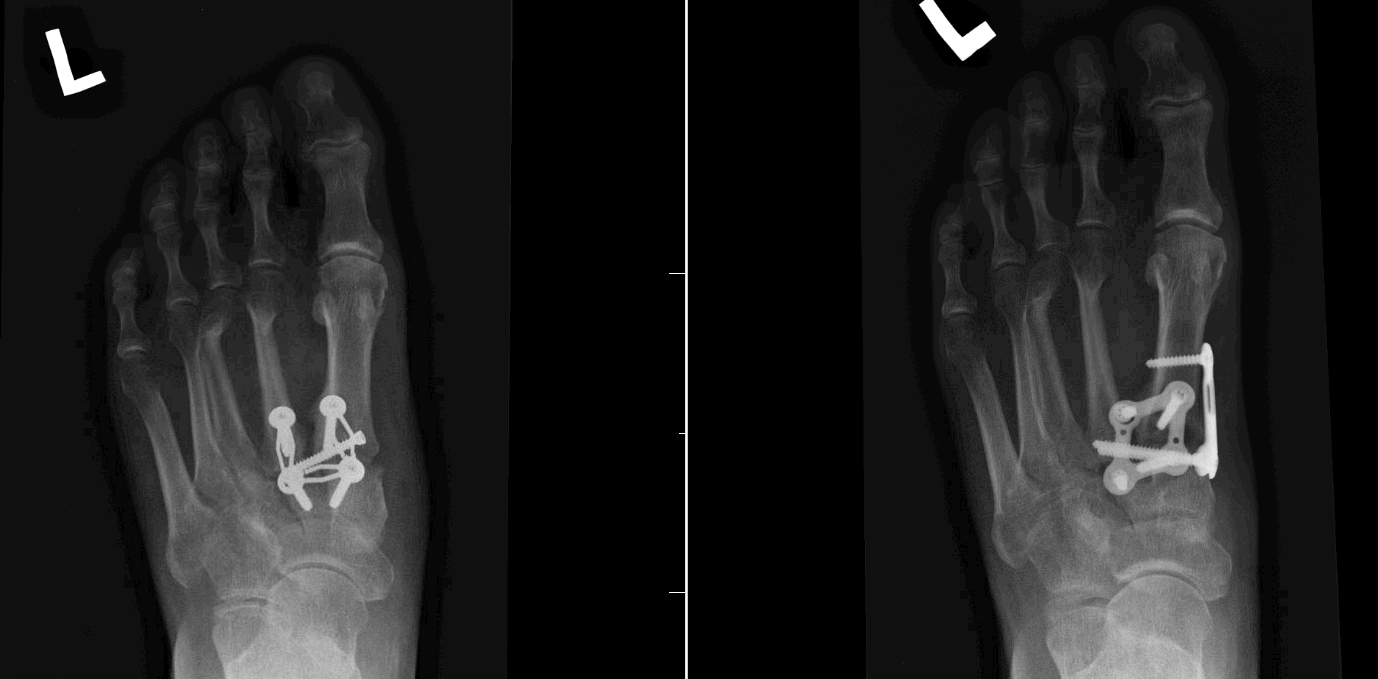 www.lisfranc.ca - Lisfranc Fracture / Injury Blog: Lisfranc / Midfoot ...