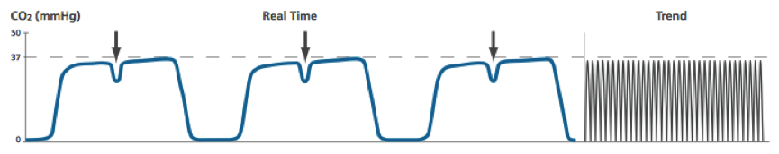 EM Didactic: Capnography beyond ROSC