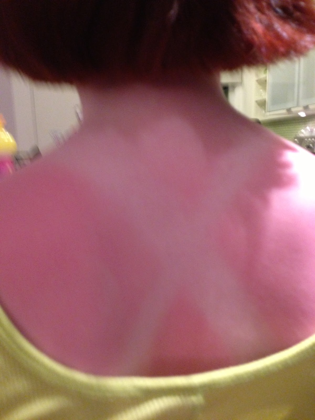 No Turning Back: Mom Guilt: Sunburn Déjà Vu