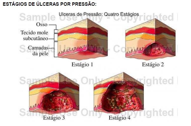 Úlcera por Pressão