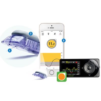 Diabetes Information: Dexcom G5 Continuous Glucose Monitor - New ...