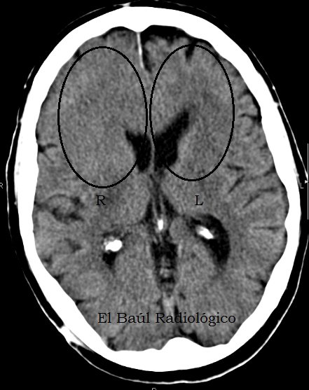 El Baúl Radiológico: LESIONES INVISIBLES EN TOMOGRAFÍA COMPUTARIZADA ...