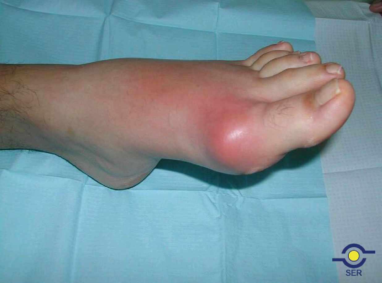 Claves de Salud: Hiperuricemia