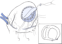 dr pankaj goel: Case of the Month- Post MI Posterior LV Aneurysm ...