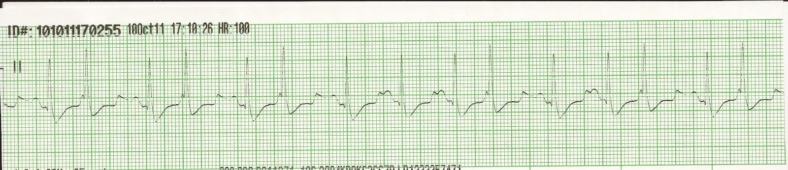 EKG Rhythm Strip Quiz 19