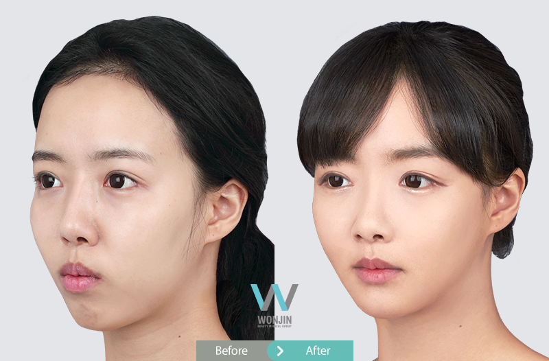 Operasi Dua Rahang, Penting untuk Memperbaiki Sisi Fungsionalnya