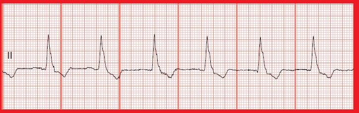 EKG Rhythm Strip Quiz 158
