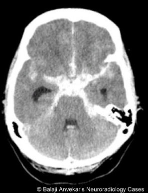 Dr Balaji Anvekar FRCR: Acom Aneurysm