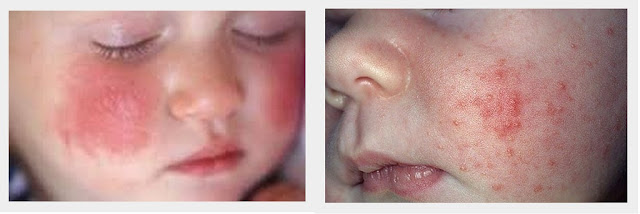 EKCEM,DERMATITIS,SVRBEŽ KOŽE