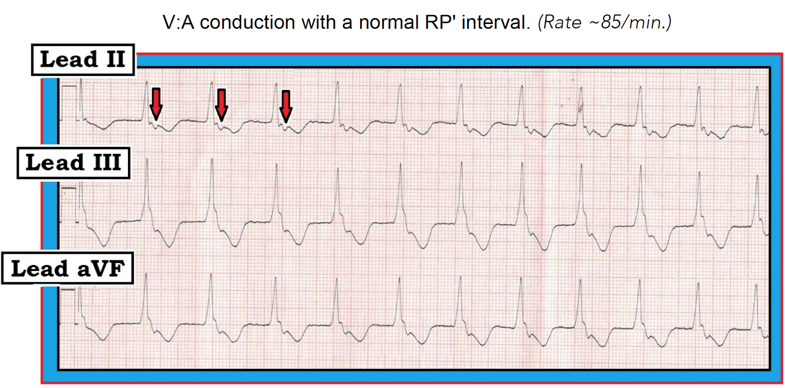 ECG Interpretation: ECG Blog #107 (PVCs - Couplets - Echo Beats - AIVR ...