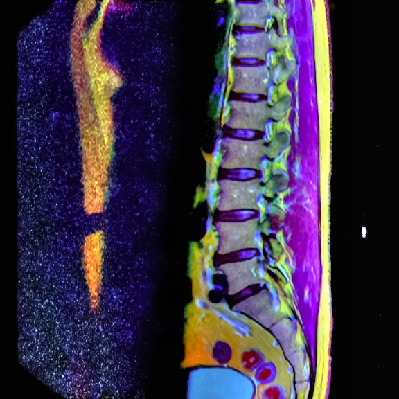 Nevit's blog: Color MRI of the Lumbar vertebrae