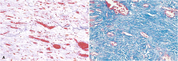 Dentistry and Medicine: Regeneration healing (repair)-General Pathology ...