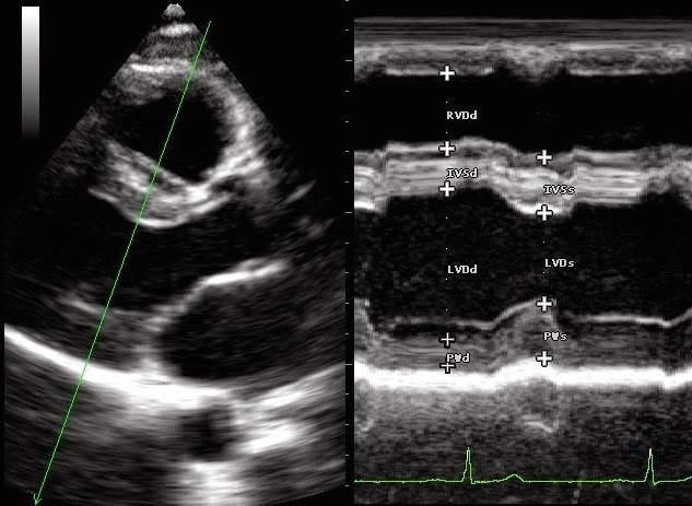 Champagne Tap: Ultrasound "forEM": POCUS-FOCUS #1: Recognizing ...