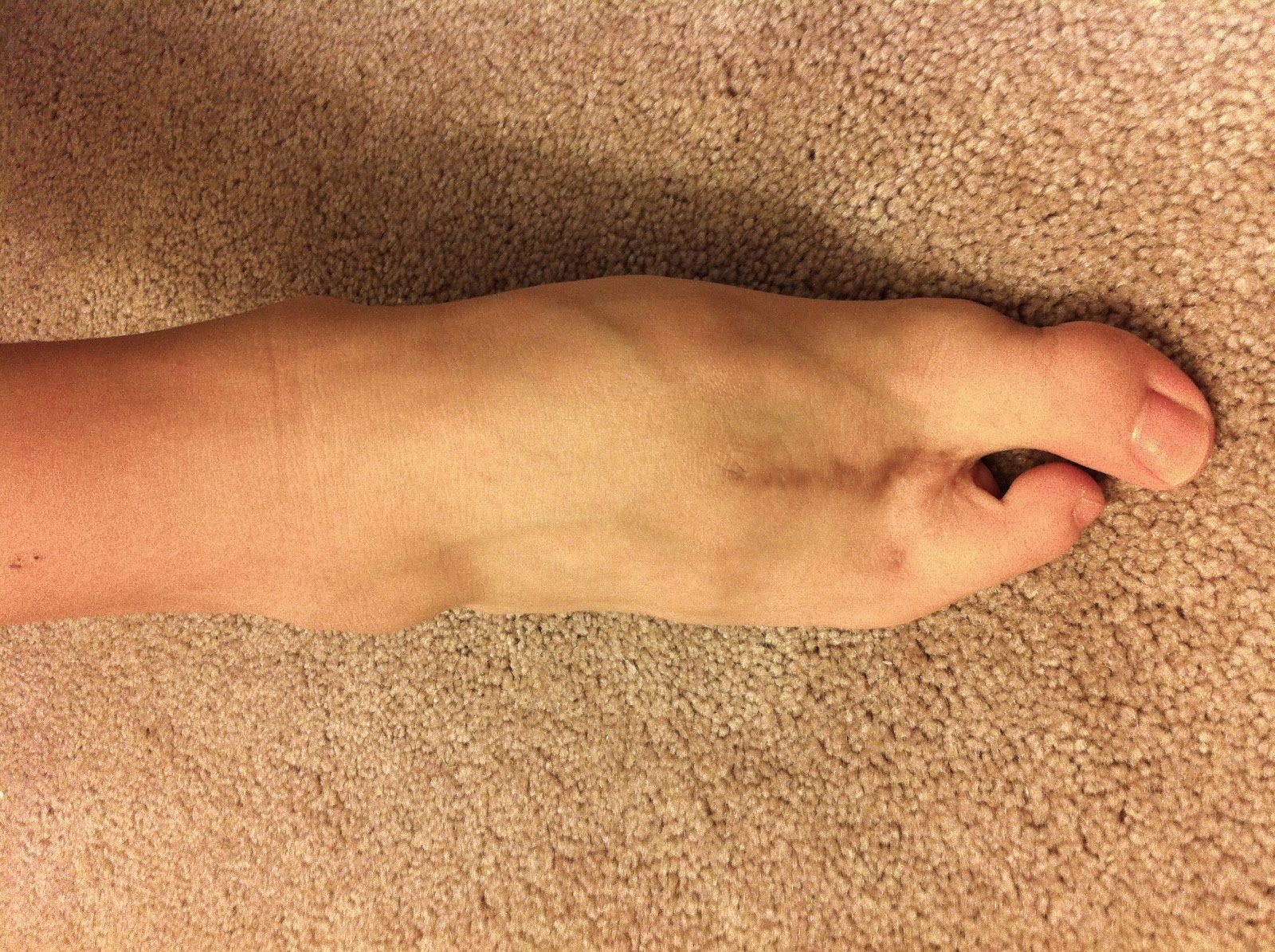 Thomsic Family: Syndactyly foot repaired