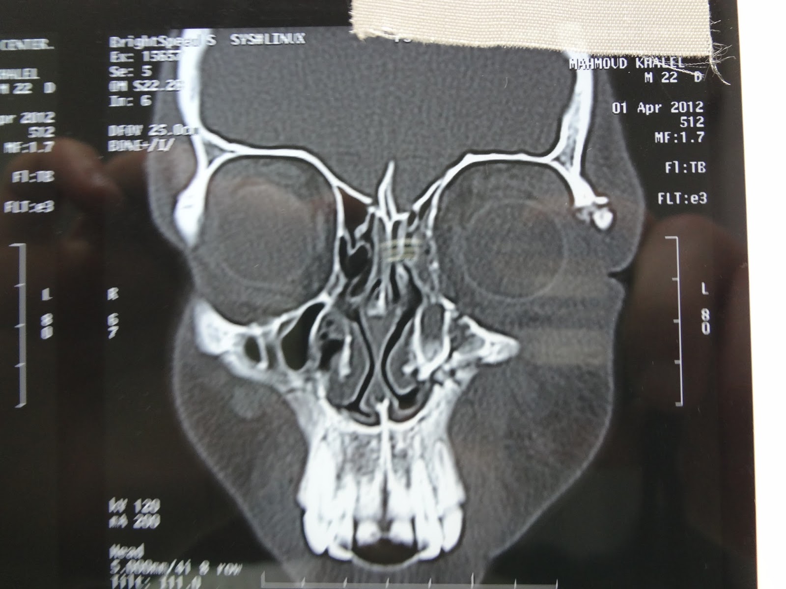zygomaticomaxillary fracture fixation by plates and screws, CT axial ...