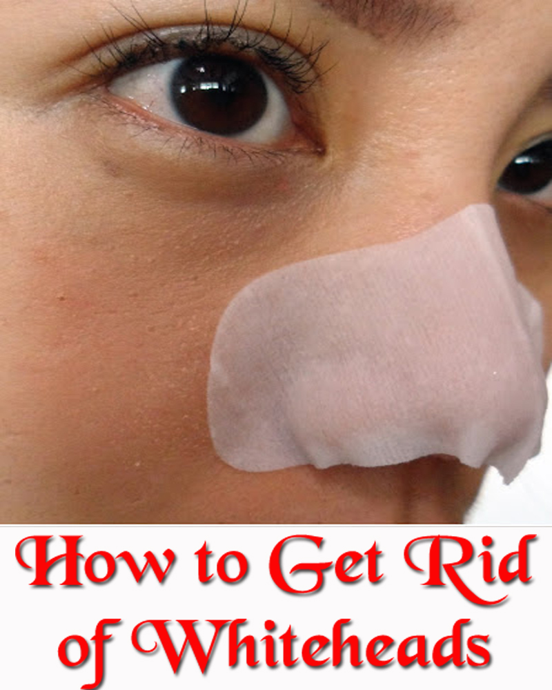 How To Get Rid Of Whiteheads how-to-get-rid-of-whiteheads