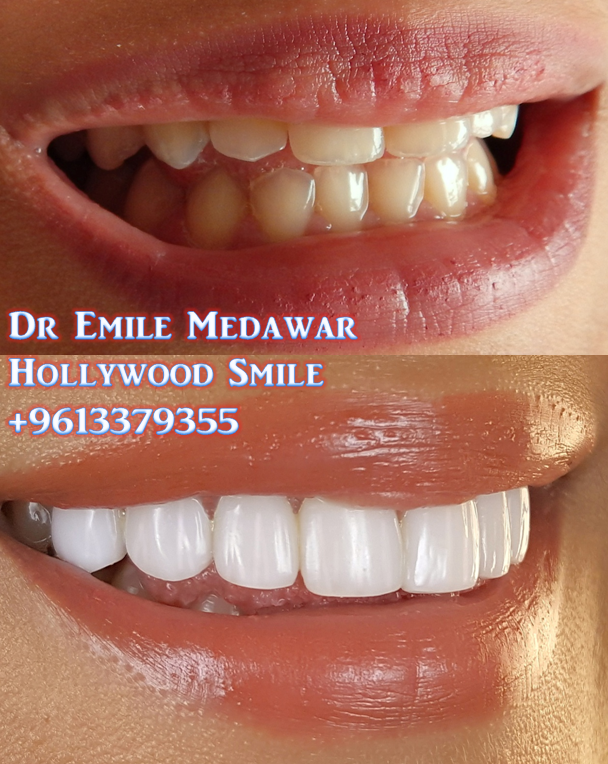 Veneer Hollywood Smile, Dr Emile Medawar, 00961 3 379355: October 2018