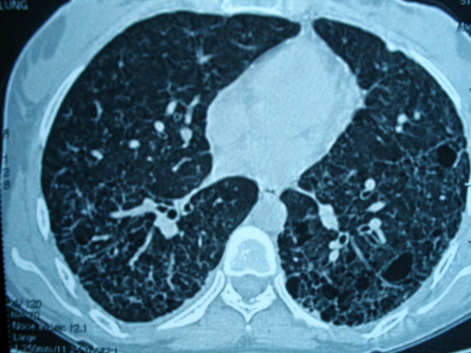 Enfermedades Raras: Histiocitosis X