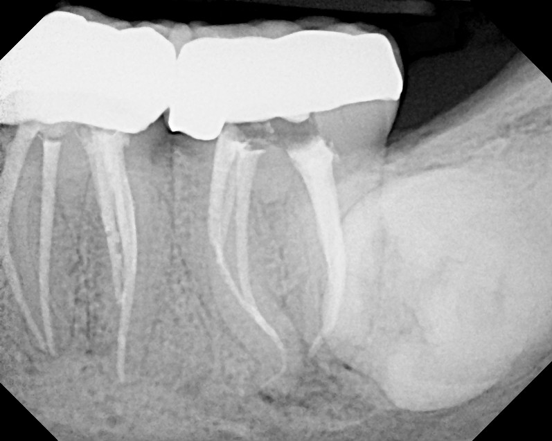 The Endo Blog: Persistent Post-Treatment (Apical) Periodontitis.