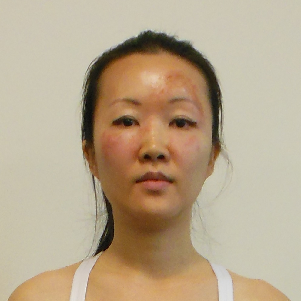 My Staph Story: My Staph Story