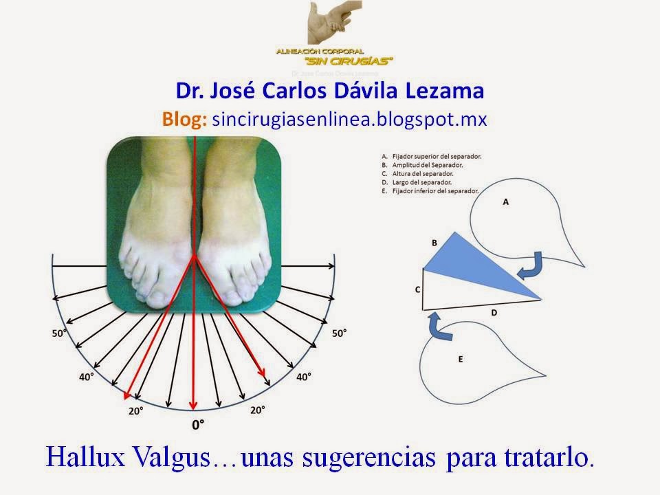 SIN CIRUGÍAS en LÍNEA: HALLUX VALGUS...sugerencias