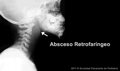 SALUDando a Los Cabos: Absceso periamigdalino