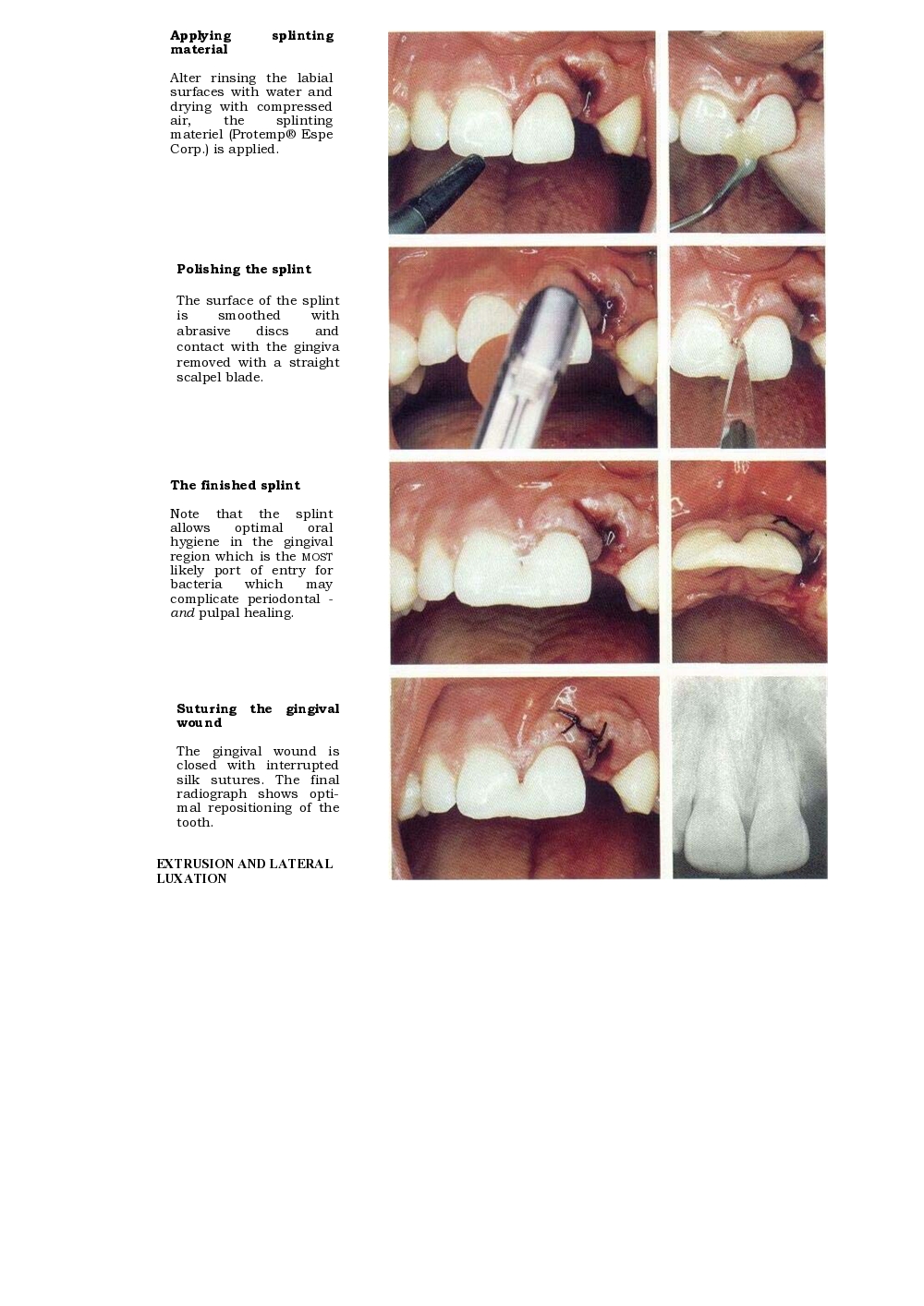 DOs and DONTs in DENTISTRY: CONCUSSION ,SUBLUXATION,EXTRUSION ,LATERAL ...