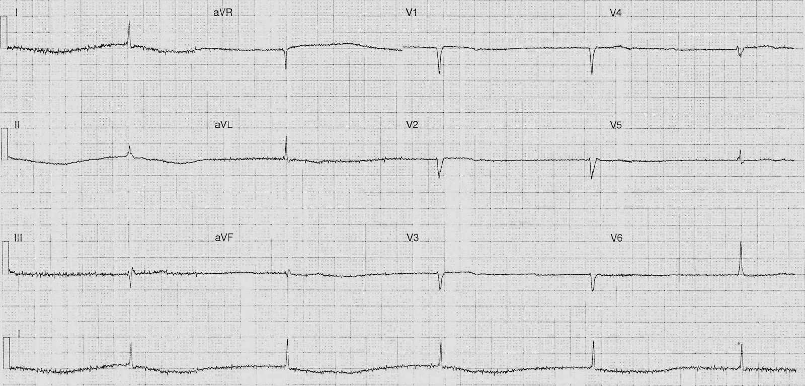 ECG of the Week: ECG of the Week - 16th February 2015 - Interpretation