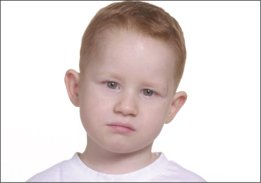 What is Sandifer Syndrome - Definition, Symptoms, Causes, Treatment ...