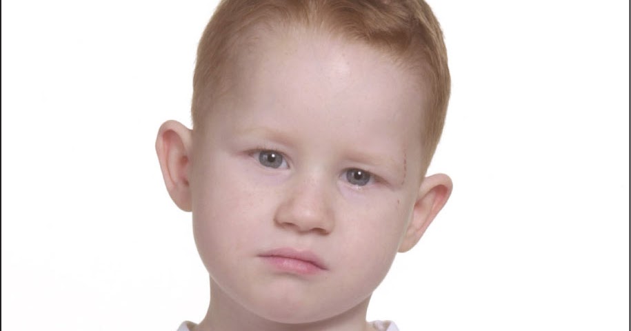 What is Sandifer Syndrome - Definition, Symptoms, Causes, Treatment ...