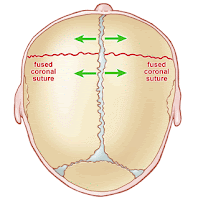 Nossa jornada com a craniossinostose: O que é craniossinostose?