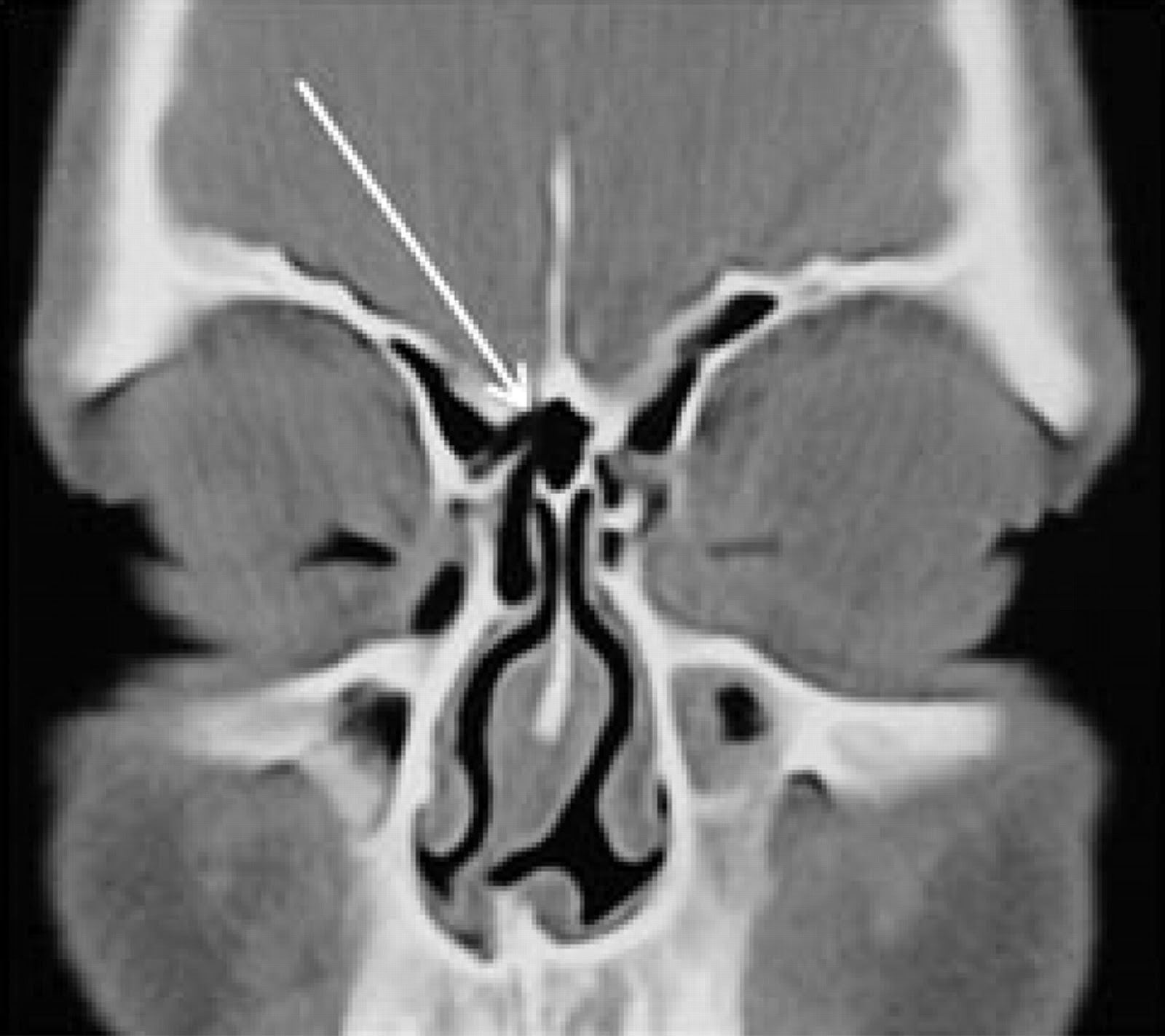 Auger Gear Image: Agger Nasi Cell