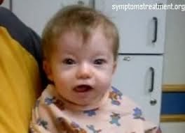 Medical Treatment Pictures-for Better Understanding: DiGeorge Syndrome