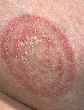 Advanced Skin Clinic: How to Identify and Treat Ringworm