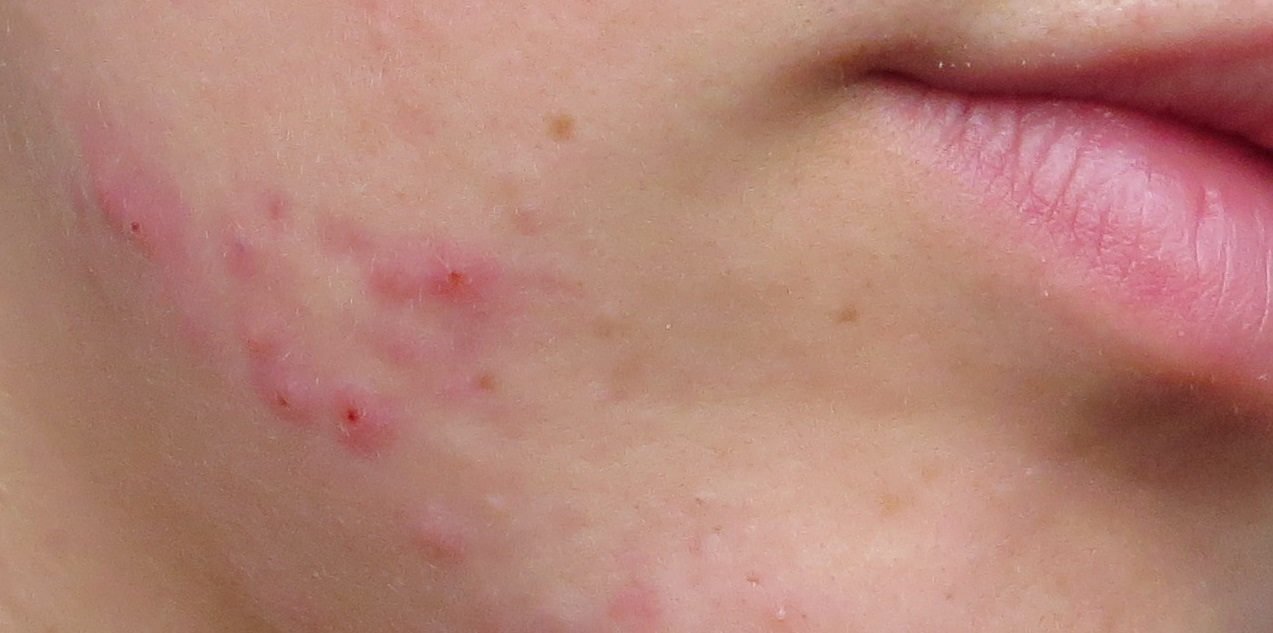 My Skin's Journey : MILK Causes My ACNE!!