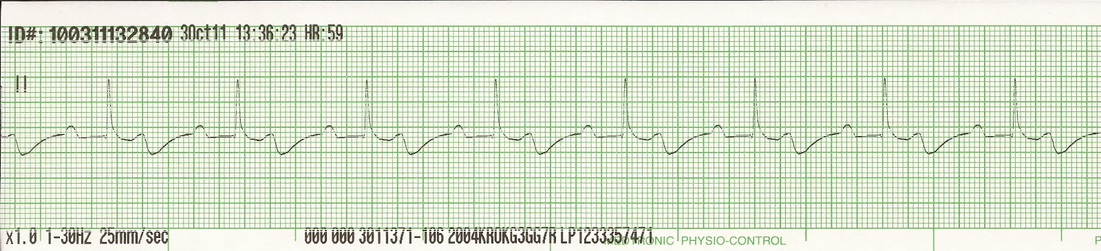 ACLS Rhythms: Heart blocks