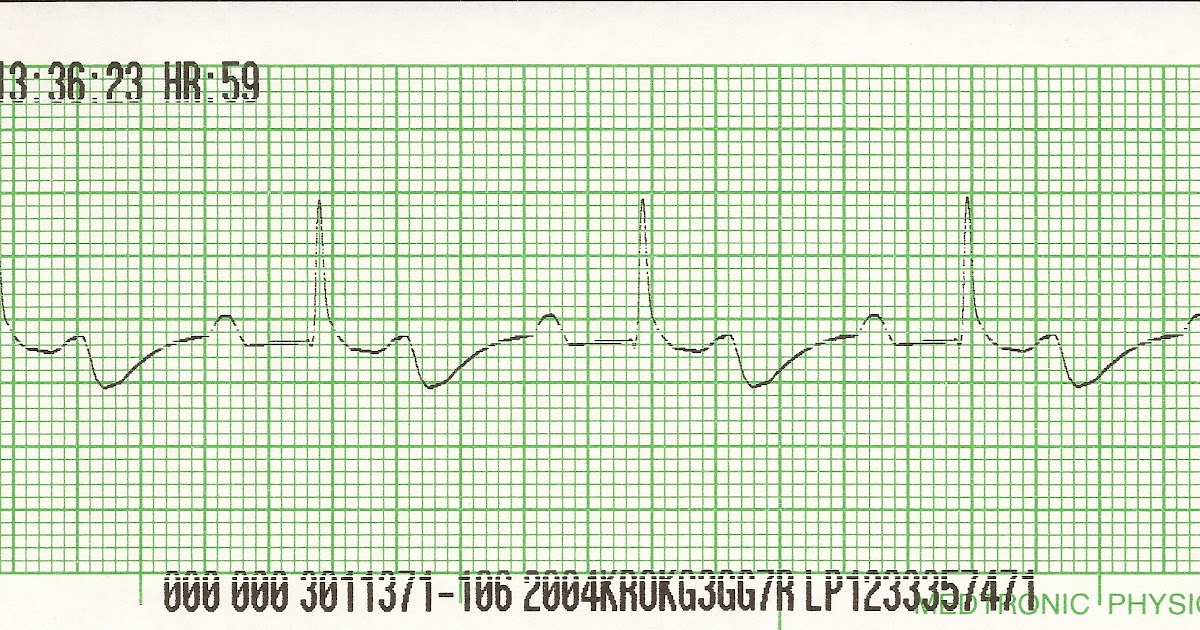 ACLS Rhythms: Heart blocks