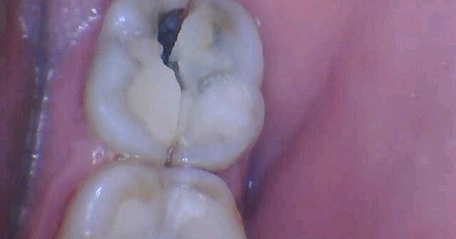 www.BestOgdenDentist.com Blog: Tooth completely broken in half!