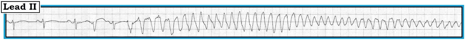 ECG Interpretation: ECG Interpretation Review #36: (WCT - VT - A Fib ...