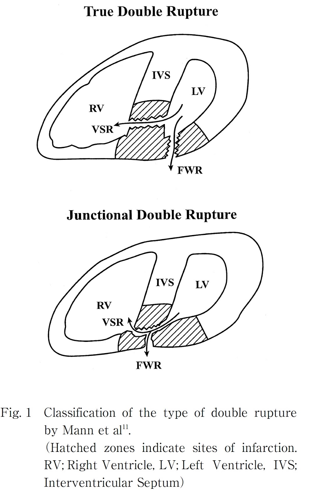 松下 ER ランチ・カンファレンス: Double rupture