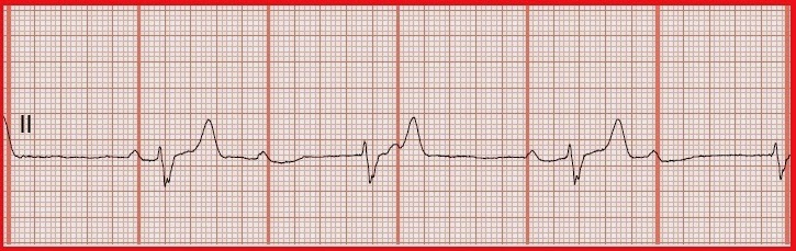 EKG Rhythm Strip Quiz 214
