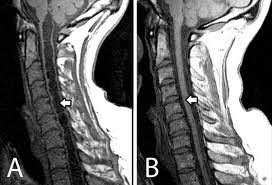 Medical Treatment Pictures-for Better Understanding: Syringomyelia