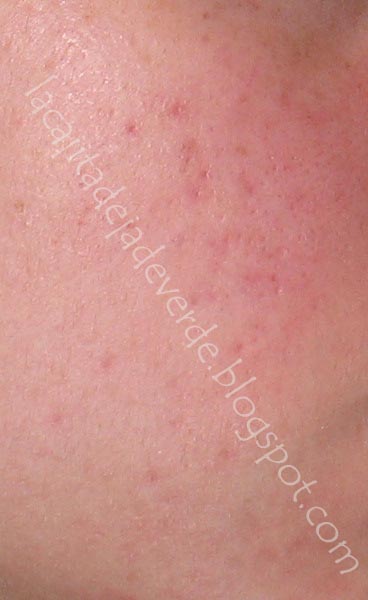 La cajita de Jade verde: Diario de una piel con acné-rosácea (VI): días ...