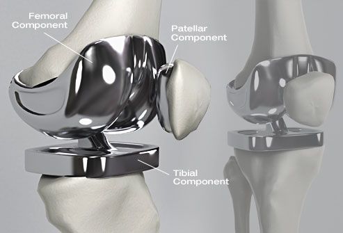 Knee Replacement Surgery In India: Assuring For The Best Recovery | Dr ...