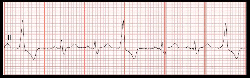 EKG Rhythm Quiz 224