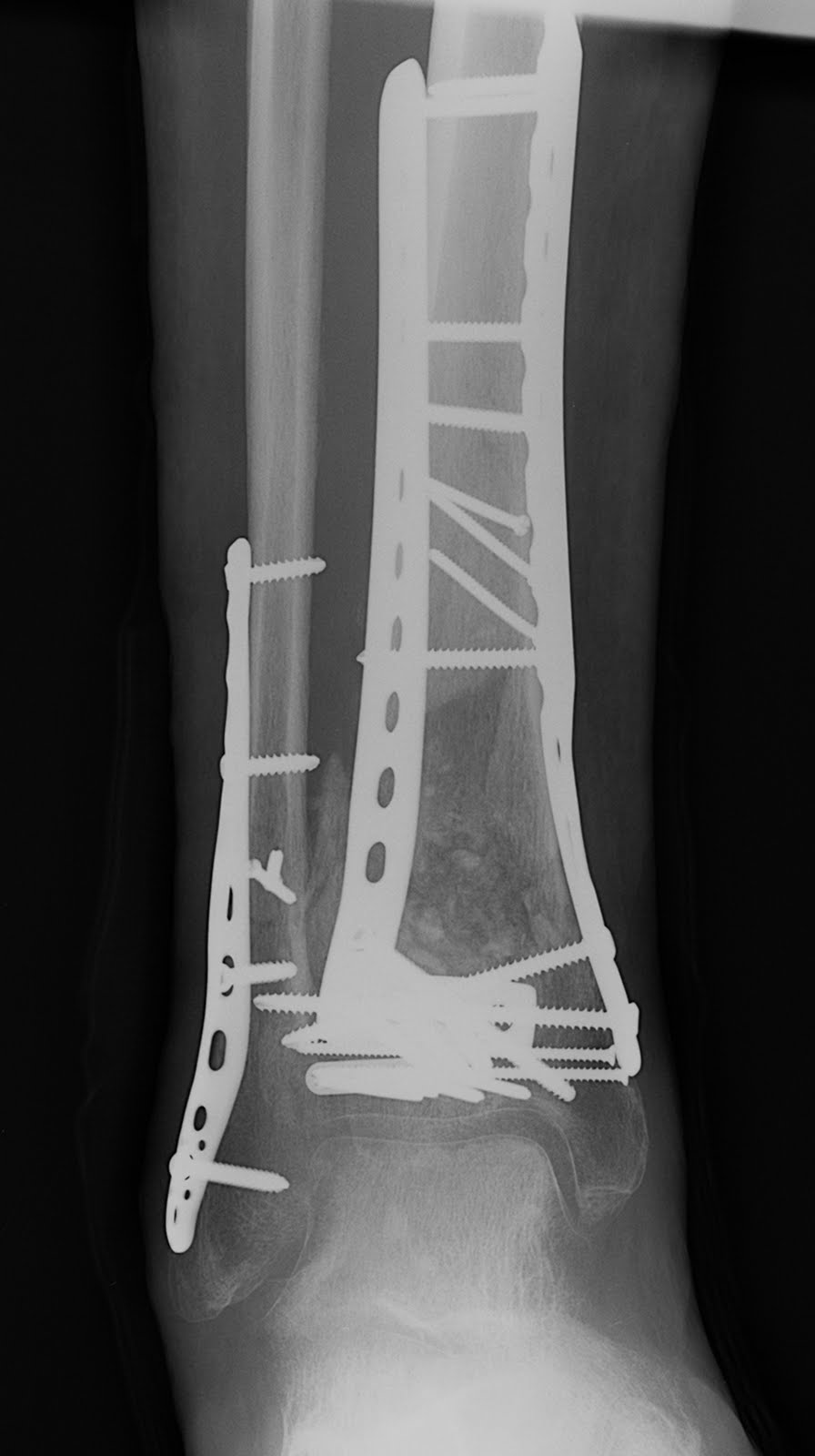 Case of the Month: Fracture cases at Harborview Medical Center ...