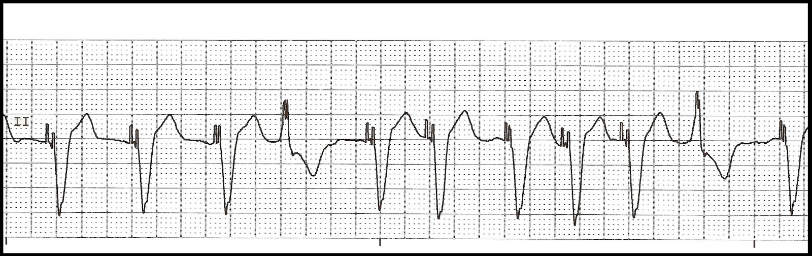 EKG Quiz 332