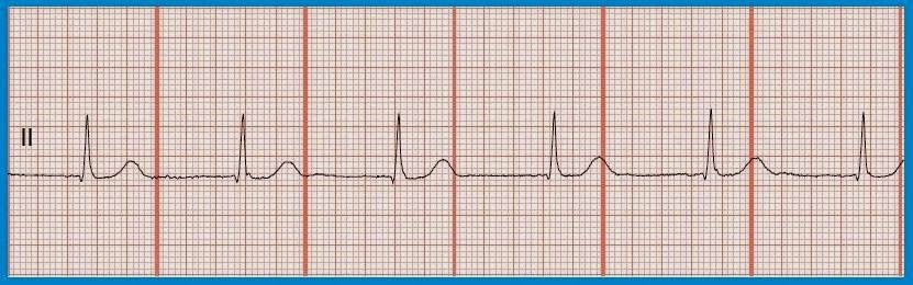 Various Junctional Rhythms