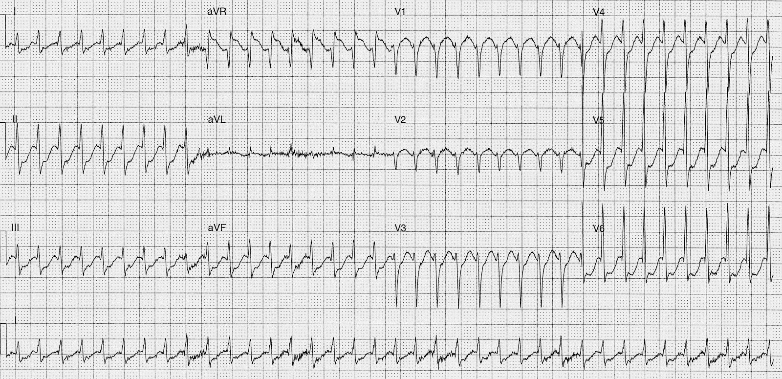 ECG of the Week: ECG of the Week - 20th January 2014 - Interpretation